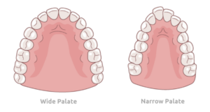 Narrow Palate and Sleep Apnea: What You Need to Know